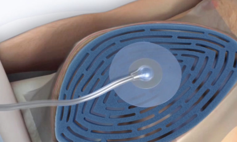 ABTHERA™ SENSAT.R.A.C™. Open Abdomen Dressing – Tri DM