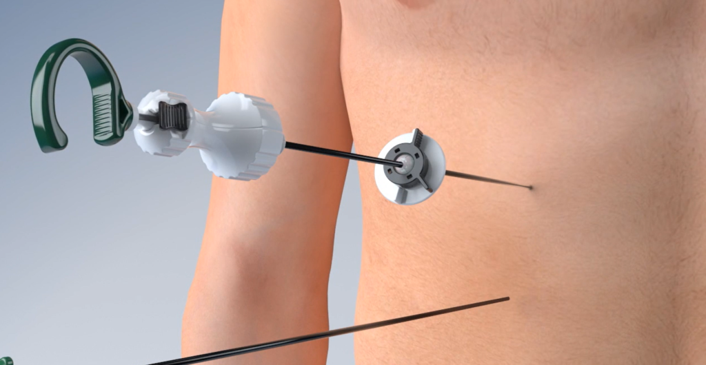 MiniLap™ Percutaneous Surgical System - Tri DM